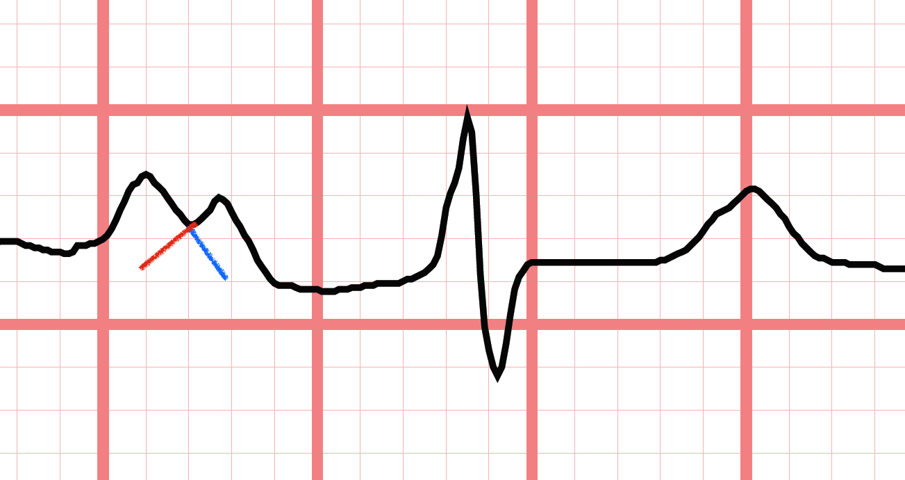 Here Are 2 Examples Of M Shaped P Waves In Lead II Here Are 2 Examples Of M Shaped P Waves In Lead II